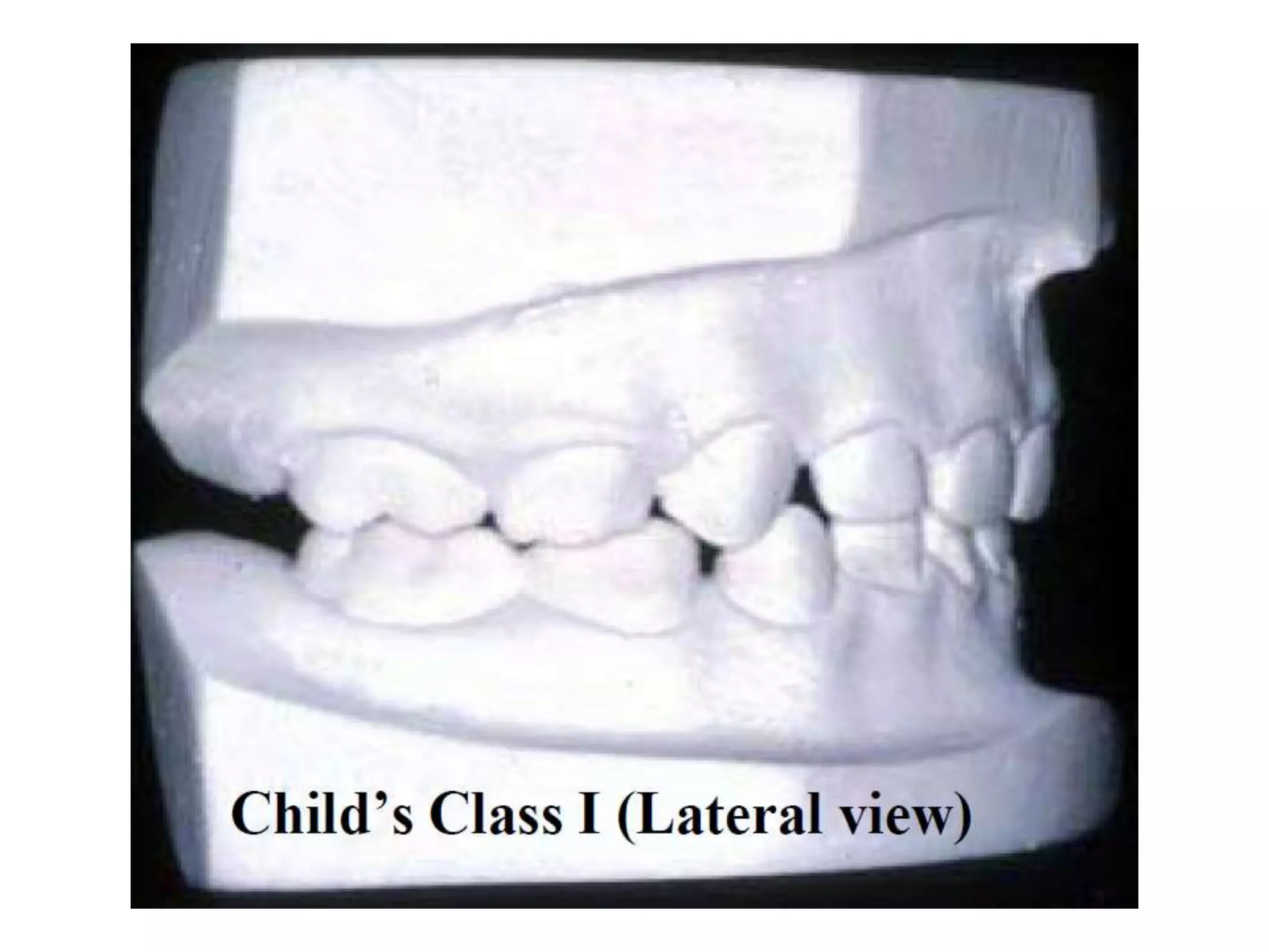 Classification of Occlusion and Malocclusion Dr. Nabil Al-Zubair | PDF