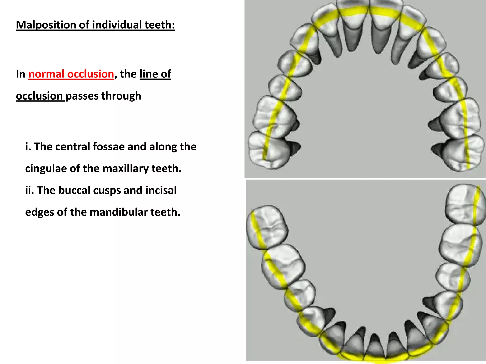 Classification of Occlusion and Malocclusion Dr. Nabil Al-Zubair | PDF