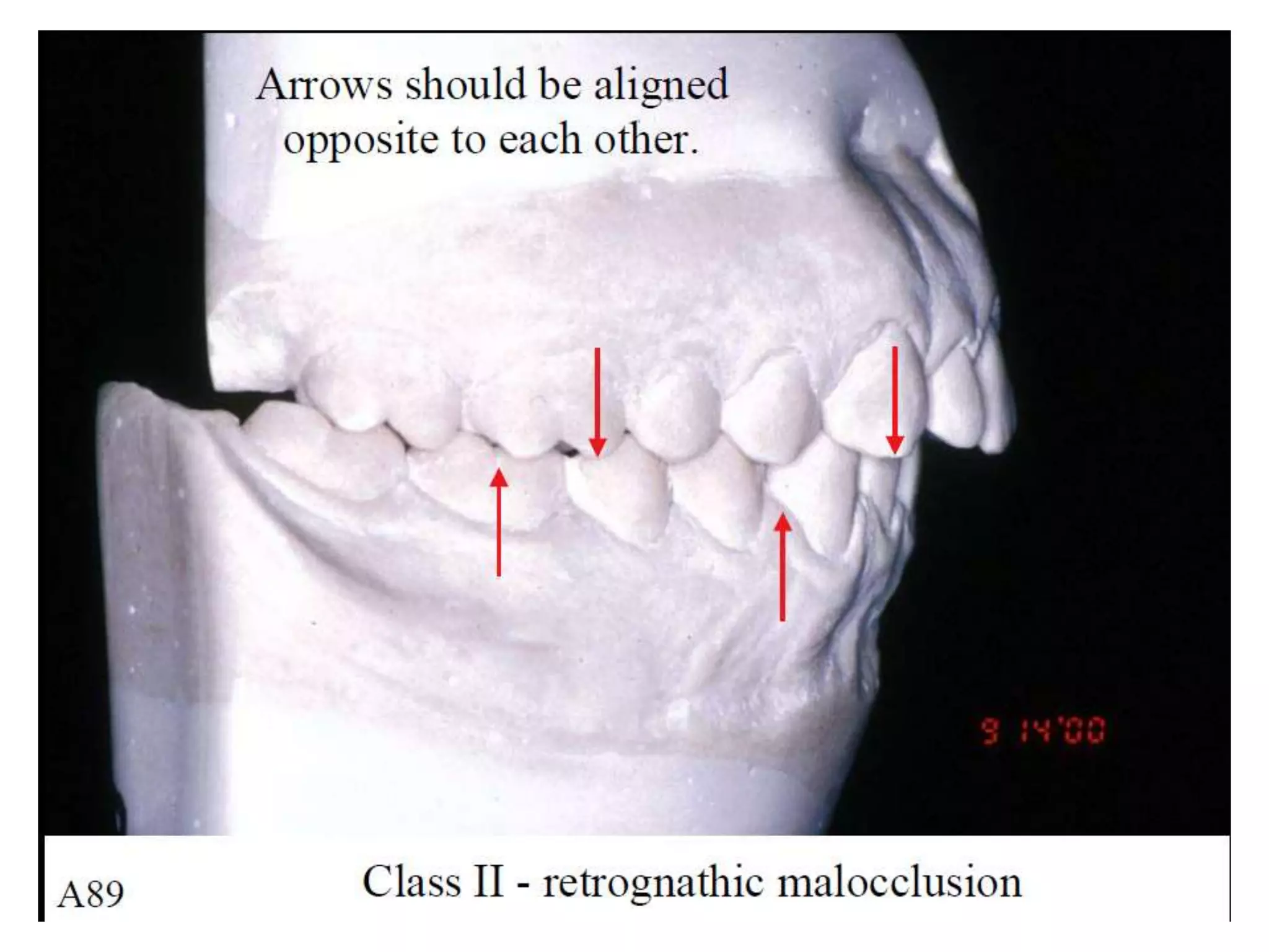 Classification of Occlusion and Malocclusion Dr. Nabil Al-Zubair | PDF