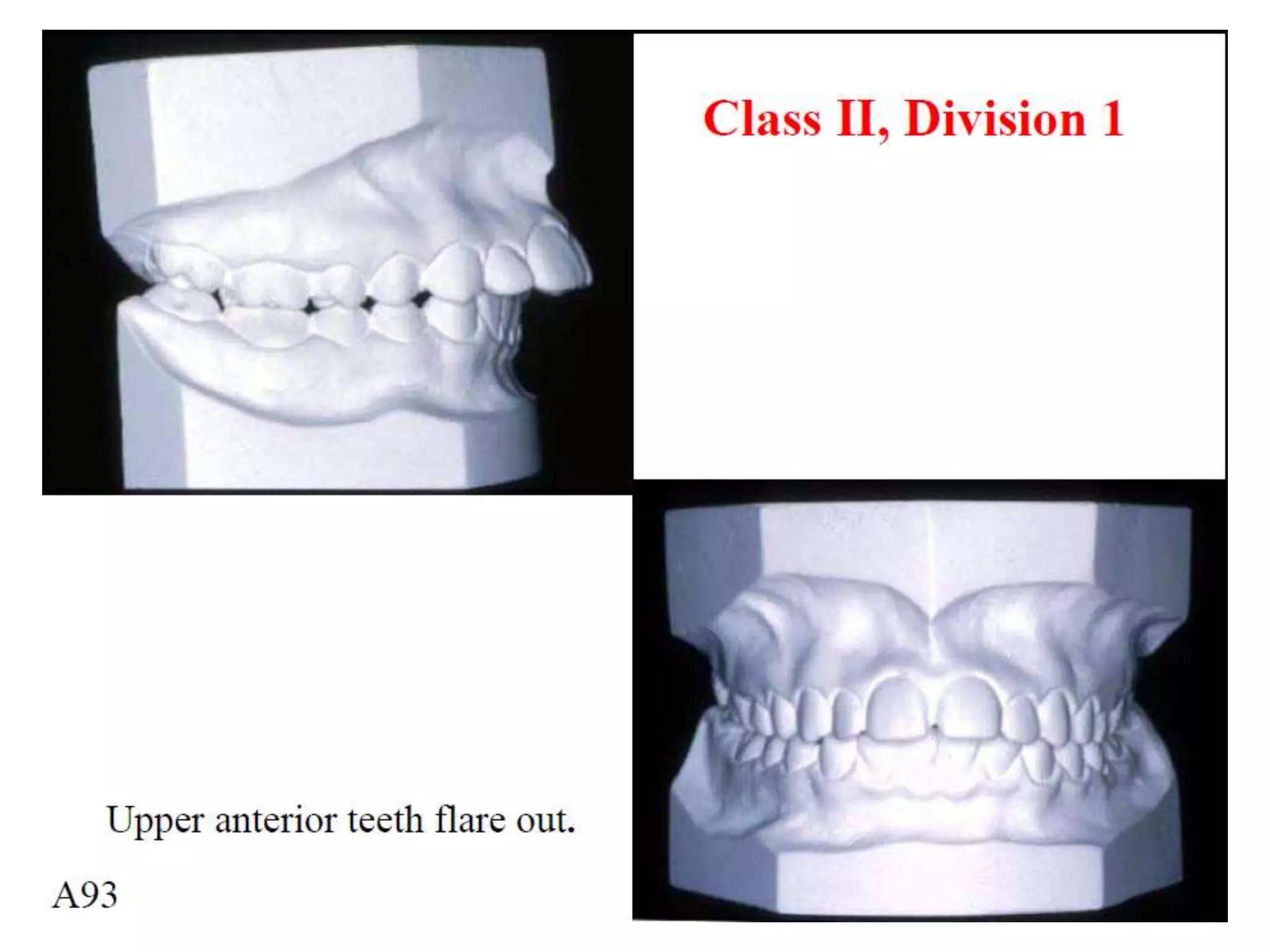 Classification of Occlusion and Malocclusion Dr. Nabil Al-Zubair | PDF