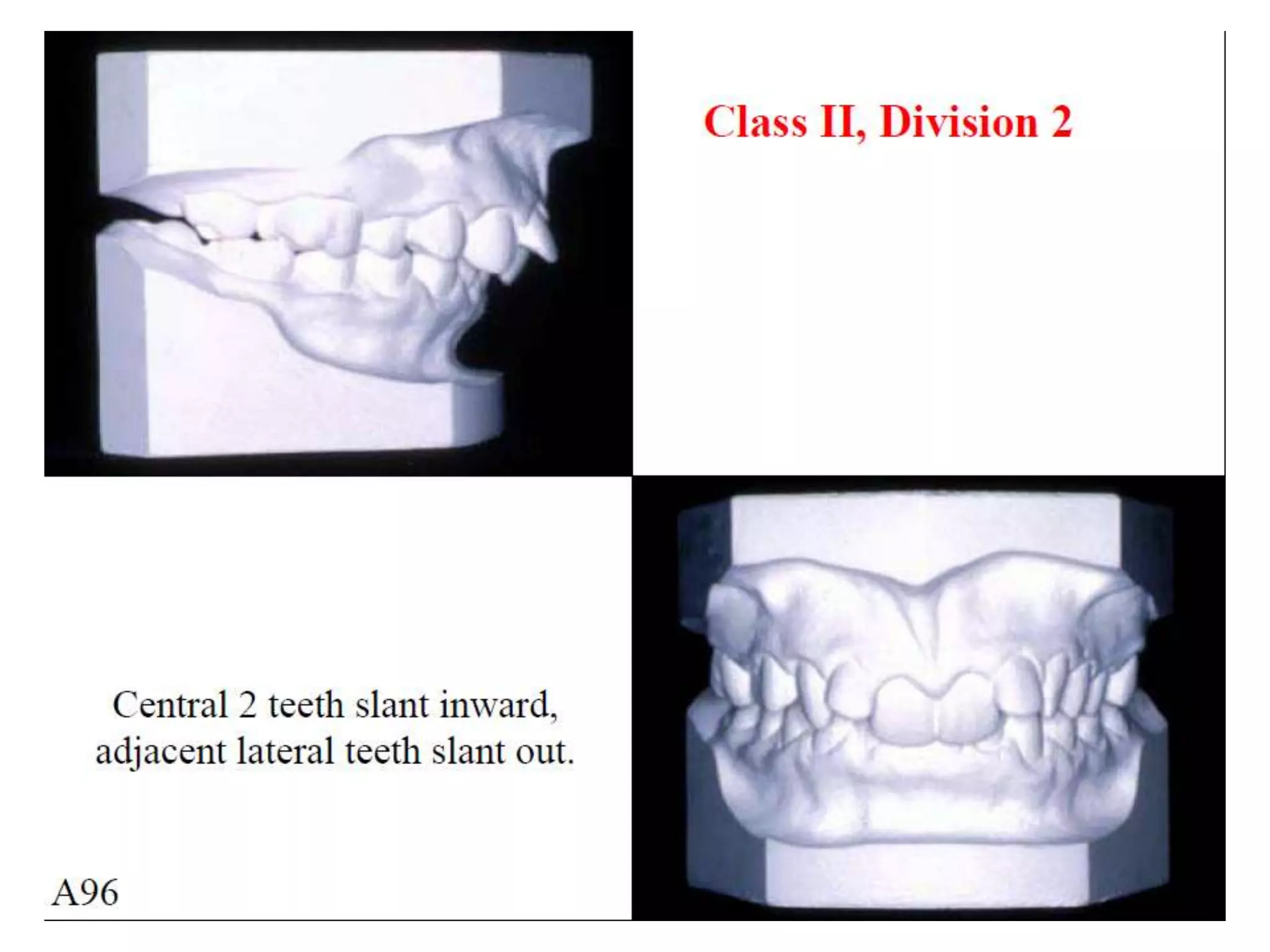 Classification of Occlusion and Malocclusion Dr. Nabil Al-Zubair | PDF