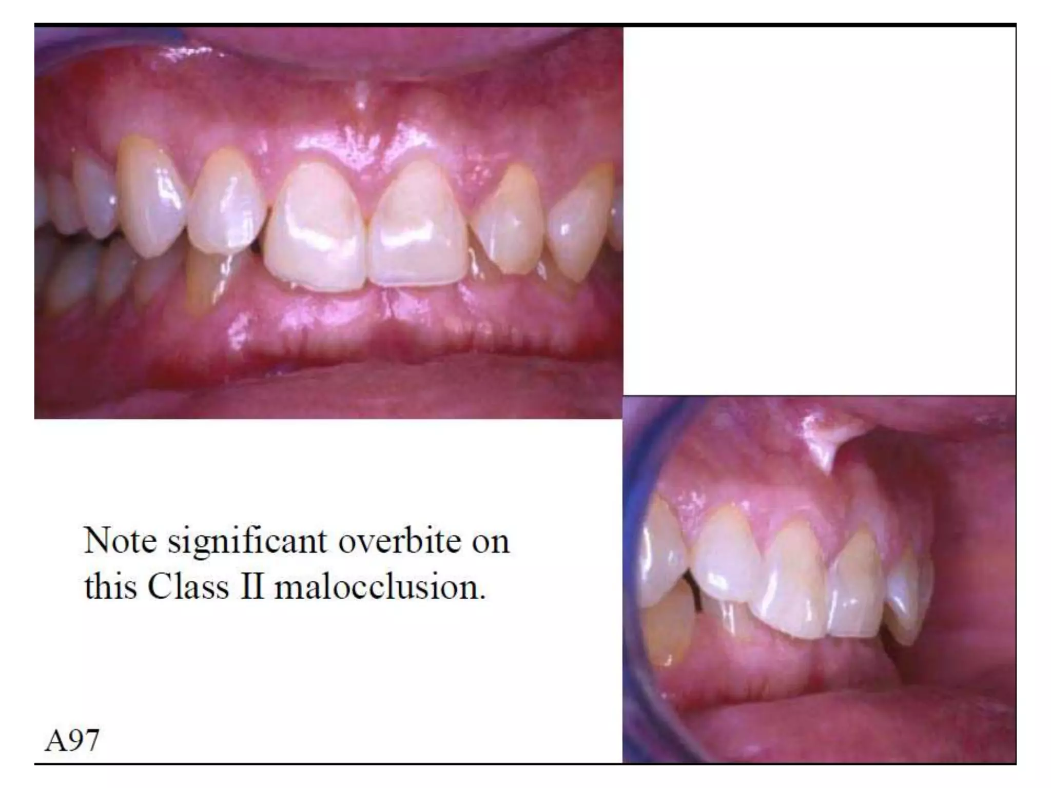 Classification of Occlusion and Malocclusion Dr. Nabil Al-Zubair | PDF