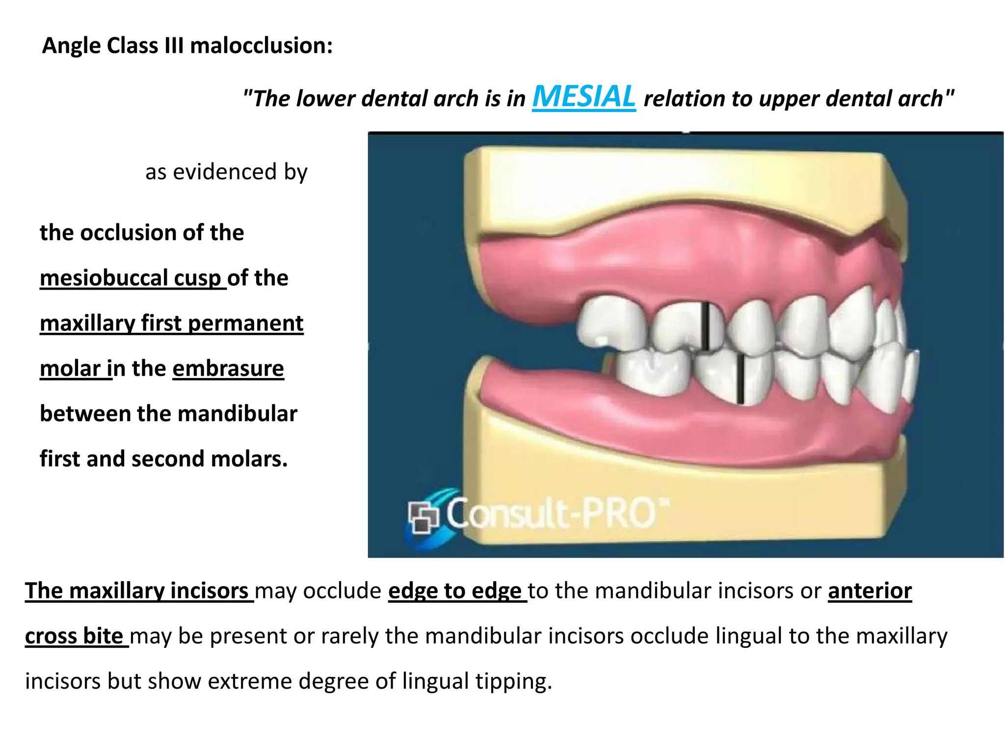 Classification of Occlusion and Malocclusion Dr. Nabil Al-Zubair | PDF