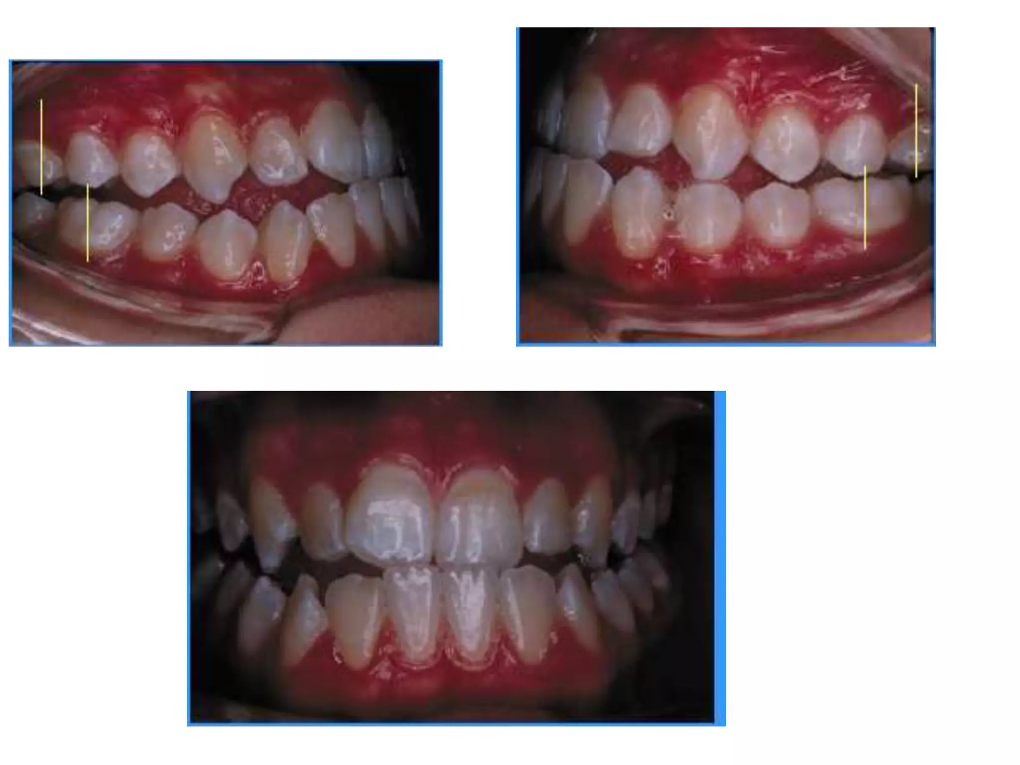 Classification of Occlusion and Malocclusion Dr. Nabil Al-Zubair | PDF