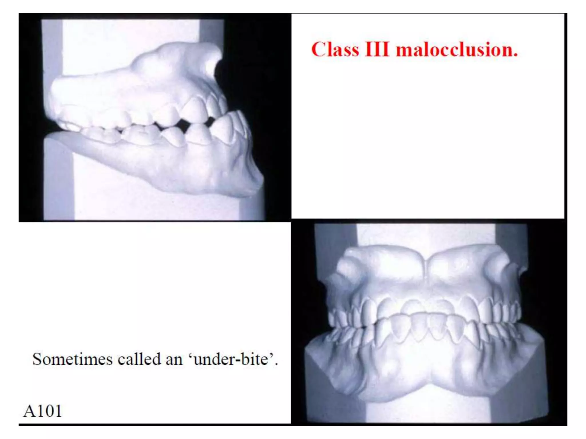 Classification of Occlusion and Malocclusion Dr. Nabil Al-Zubair | PDF