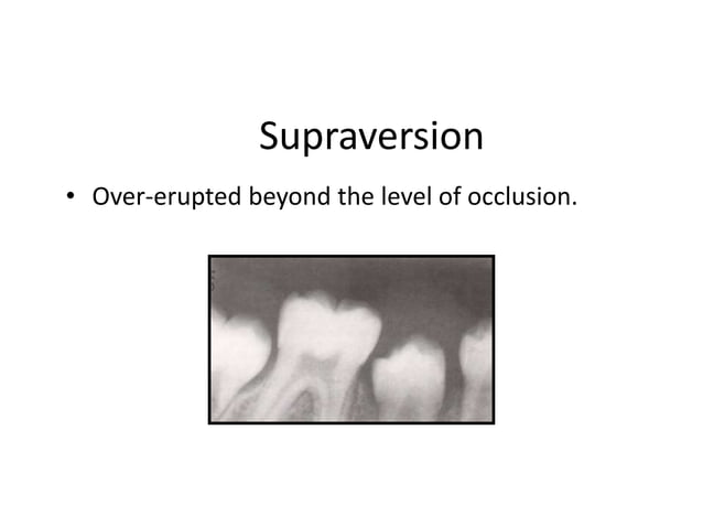 Classification of Occlusion and Malocclusion Dr. Nabil Al-Zubair | PDF