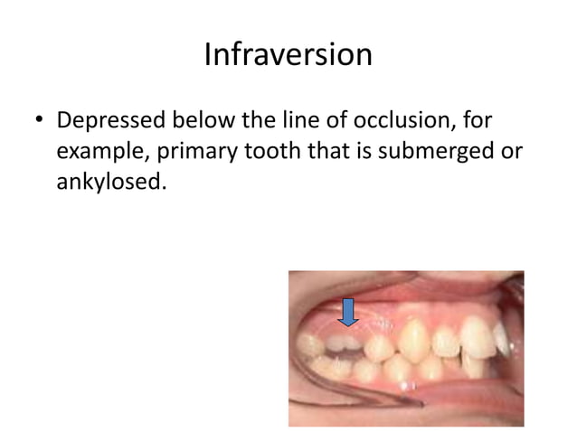 Classification of Occlusion and Malocclusion Dr. Nabil Al-Zubair | PDF