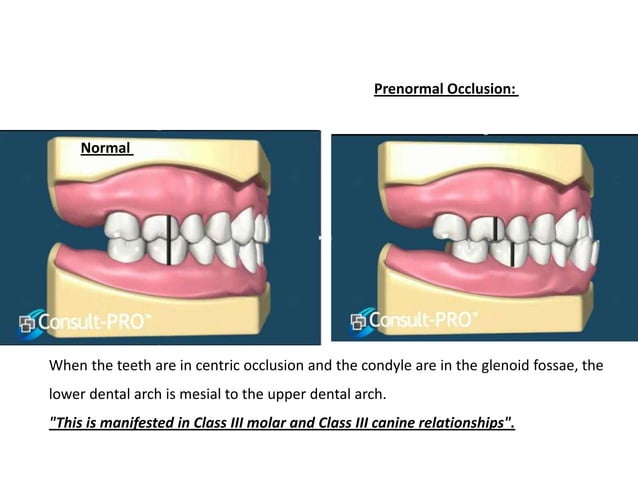 Classification of Occlusion and Malocclusion Dr. Nabil Al-Zubair | PDF