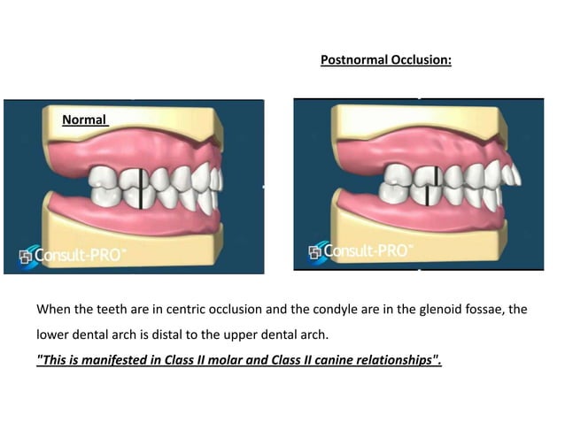 Classification of Occlusion and Malocclusion Dr. Nabil Al-Zubair | PDF