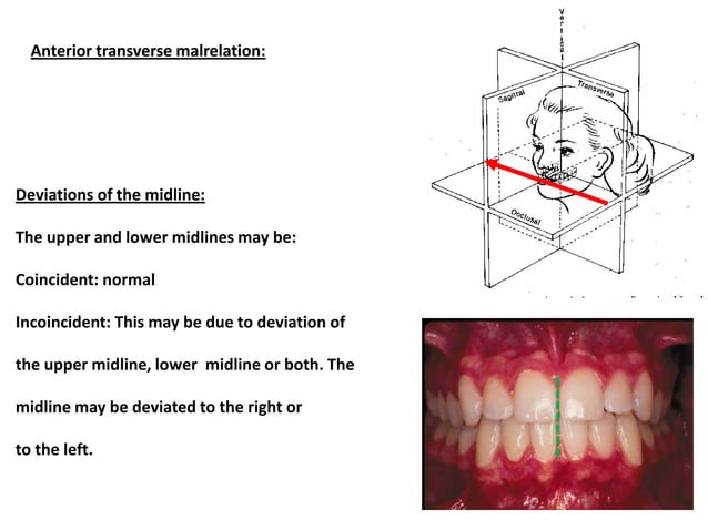 Classification of Occlusion and Malocclusion Dr. Nabil Al-Zubair | PDF