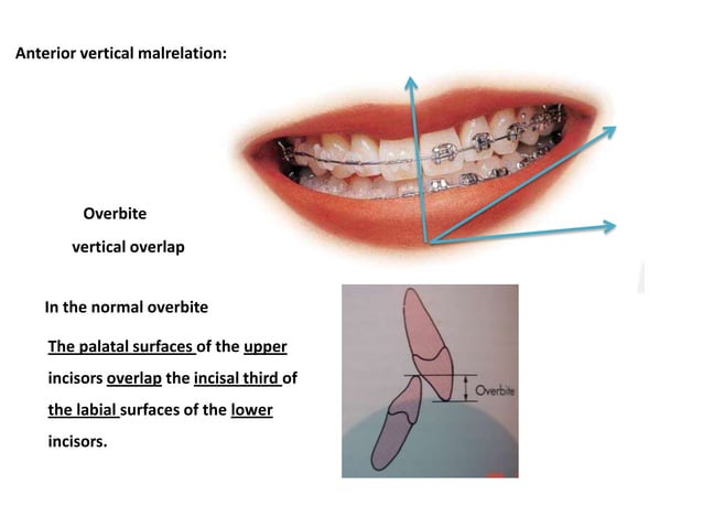 Classification of Occlusion and Malocclusion Dr. Nabil Al-Zubair | PDF