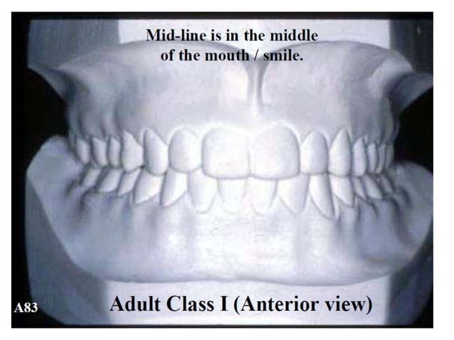 Classification of Occlusion and Malocclusion Dr. Nabil Al-Zubair | PDF
