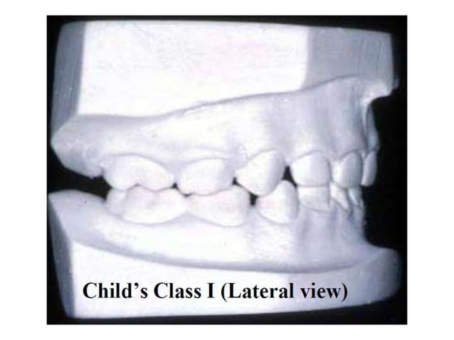 Classification of Occlusion and Malocclusion Dr. Nabil Al-Zubair | PDF