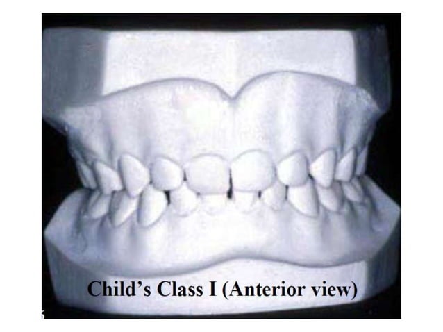 Classification of Occlusion and Malocclusion Dr. Nabil Al-Zubair | PDF
