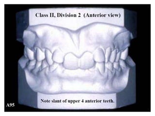 Classification of Occlusion and Malocclusion Dr. Nabil Al-Zubair | PDF