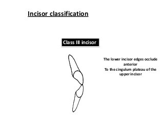 Classification of Occlusion and Malocclusion Dr. Nabil Al-Zubair | PDF