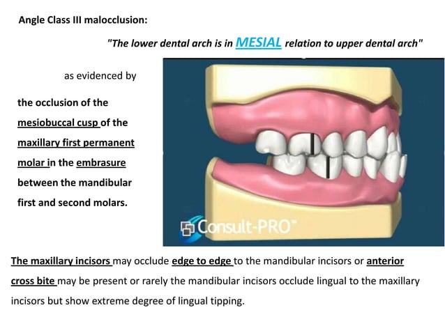 Classification of Occlusion and Malocclusion Dr. Nabil Al-Zubair