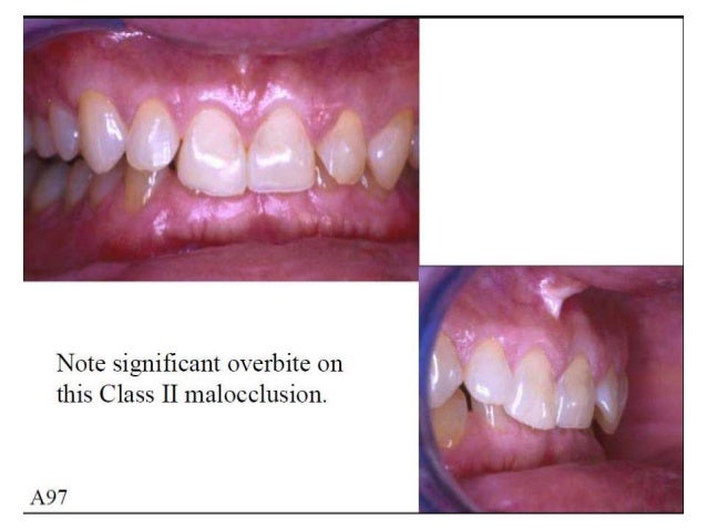 Classification of Occlusion and Malocclusion Dr. Nabil Al-Zubair