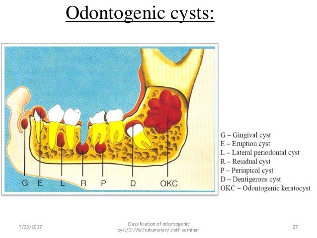 Classification of odontogenic cyst