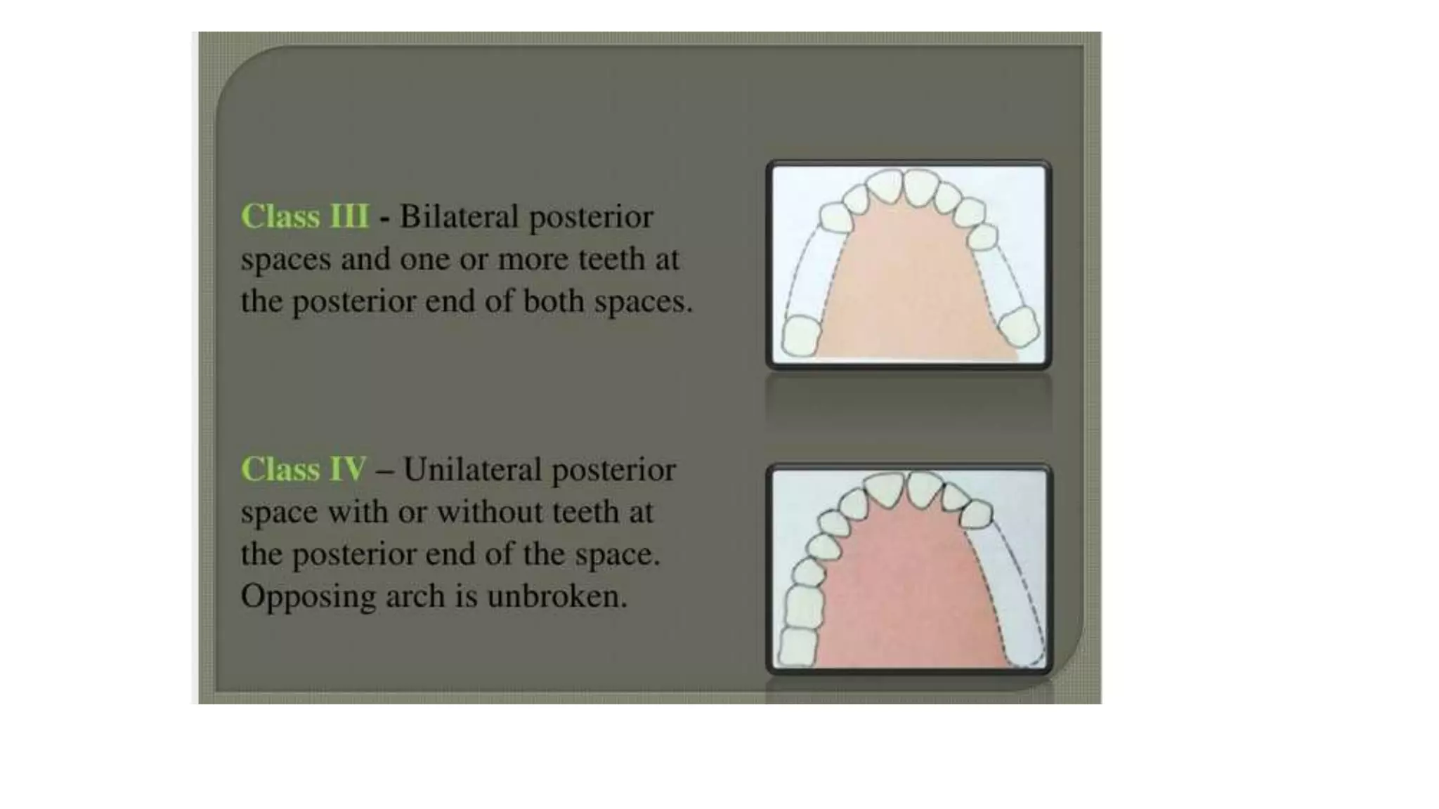 Classification of Partially Edentulous Teeth | PPT