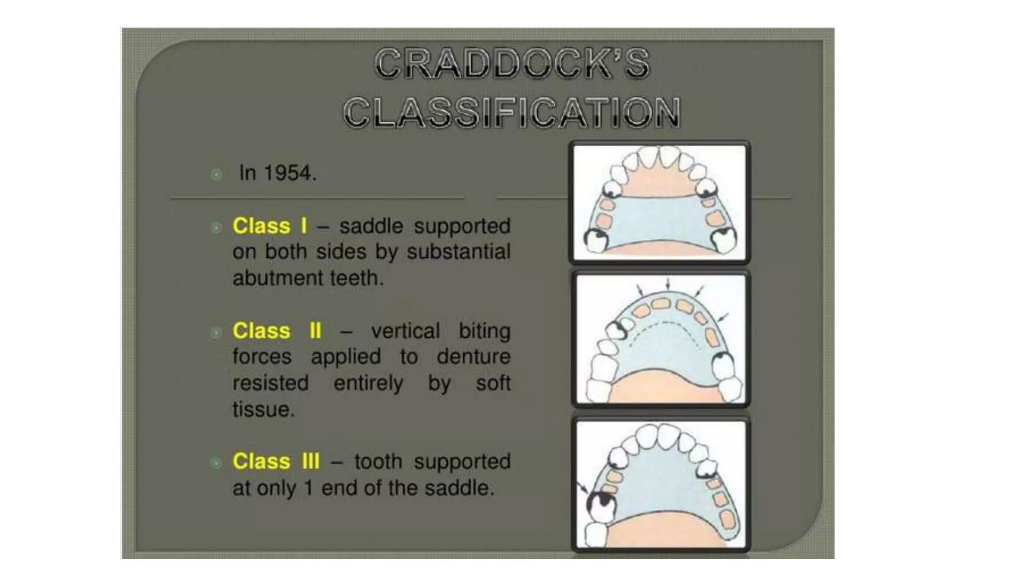 Classification of Partially Edentulous Teeth | PPT