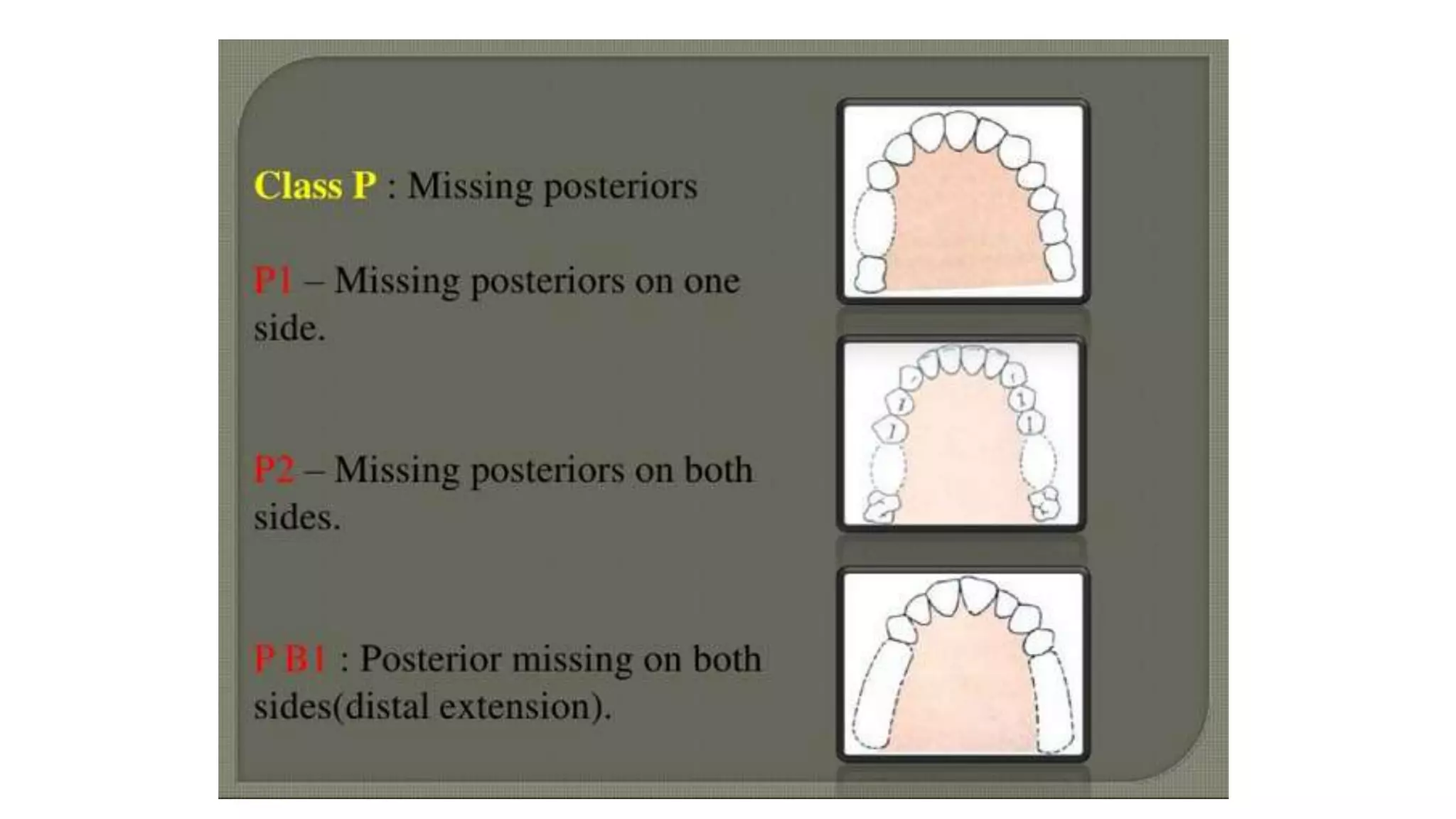 Classification of Partially Edentulous Teeth | PPT