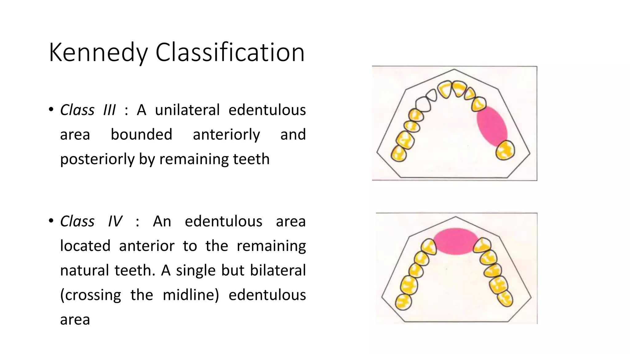Classification of Partially Edentulous Teeth | PPTX