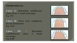 Classification of Partially Edentulous Teeth | PPT