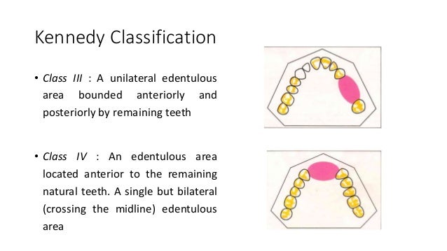 Classification of Partially Edentulous Teeth