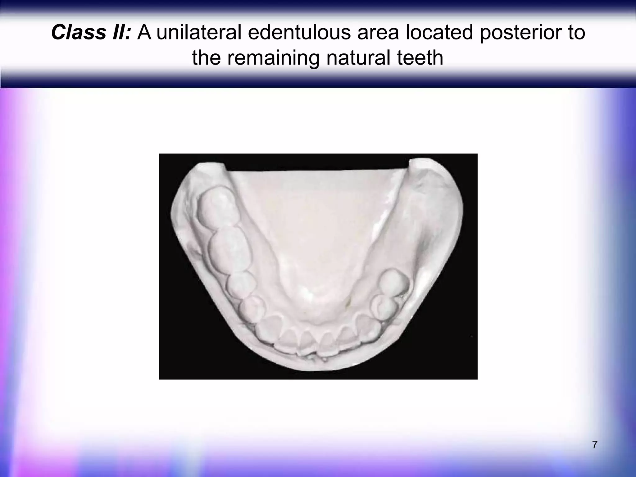 Classification of partially edentulous arches | PPT