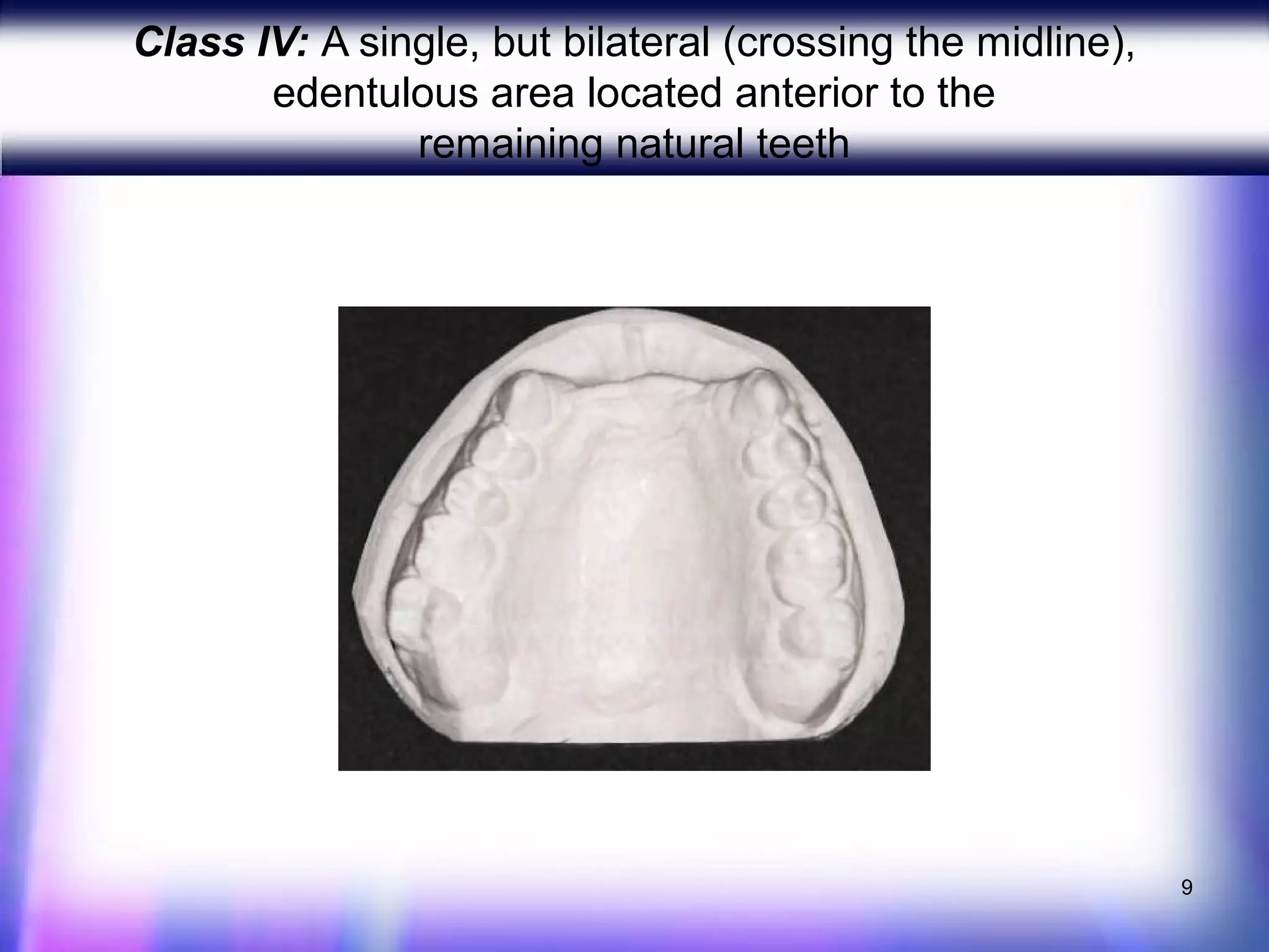 Classification of partially edentulous arches | PPT
