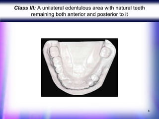 Classification of partially edentulous arches | PPT