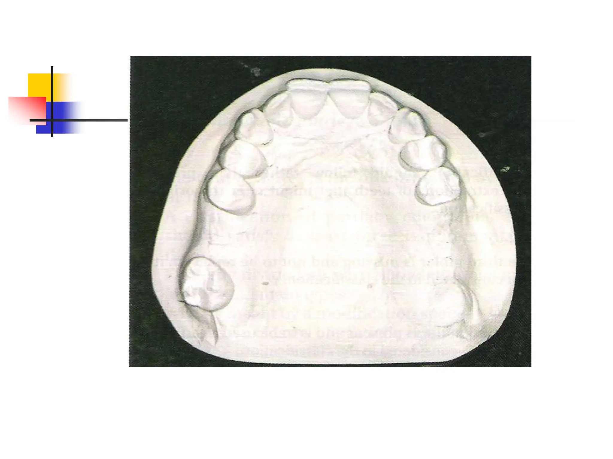 Classification of Partially Edentulous Arches.ppt