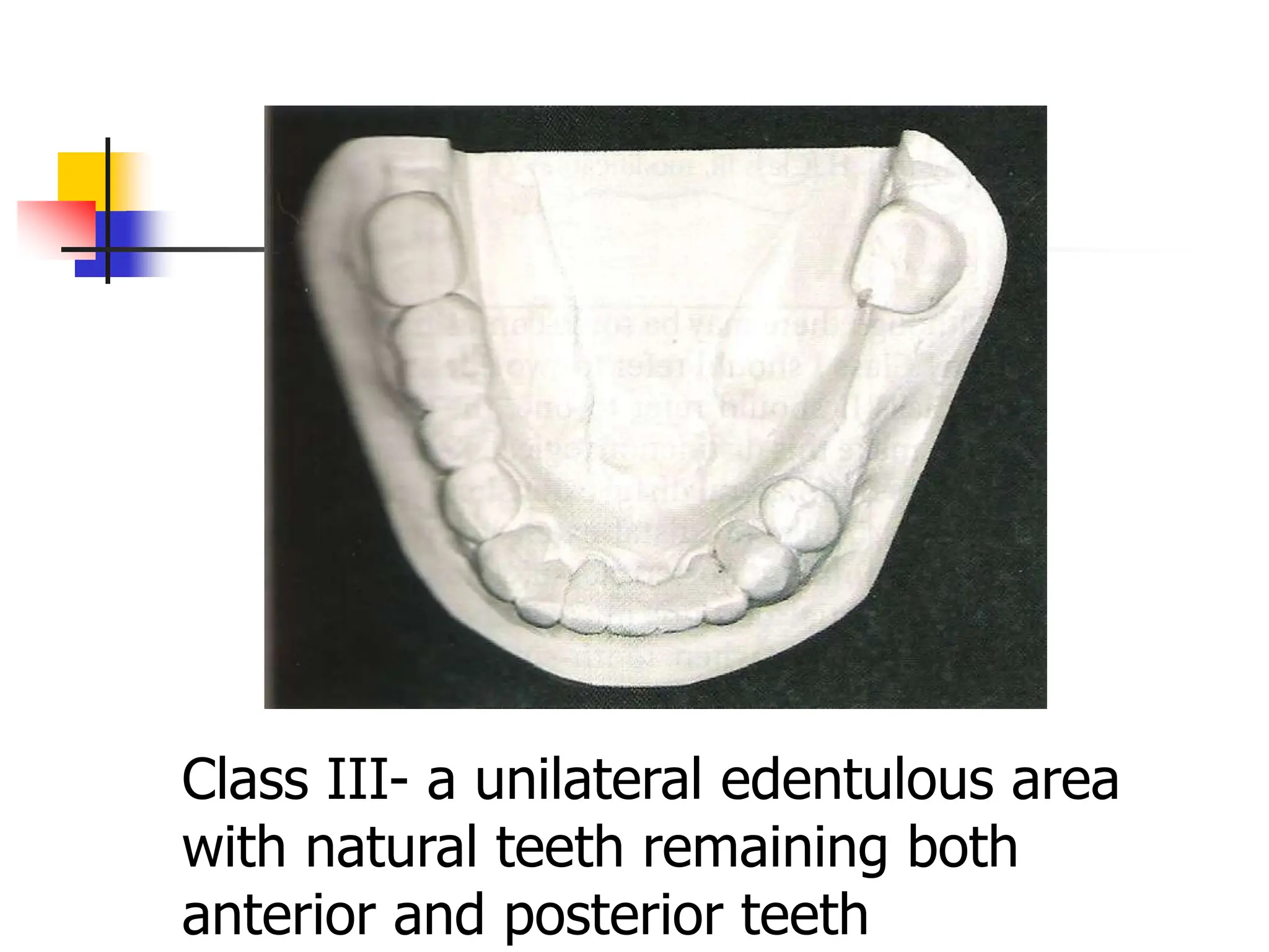 Classification of Partially Edentulous Arches.ppt