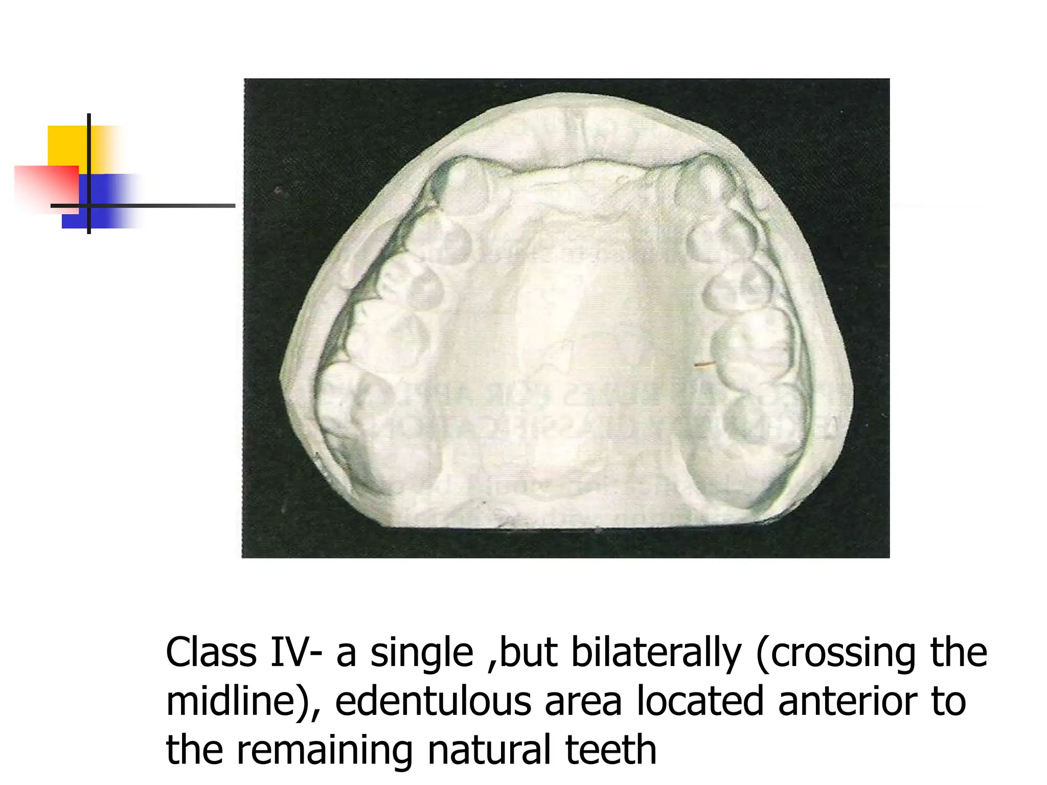 Classification of Partially Edentulous Arches.ppt