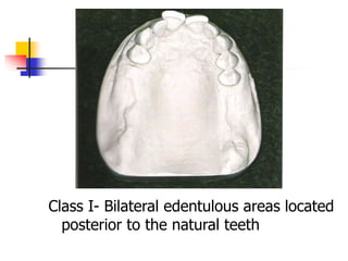 Classification of Partially Edentulous Arches.ppt