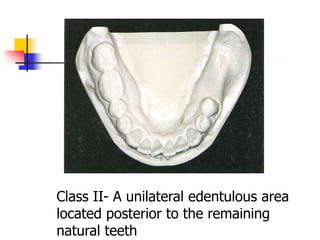 Classification of Partially Edentulous Arches.ppt