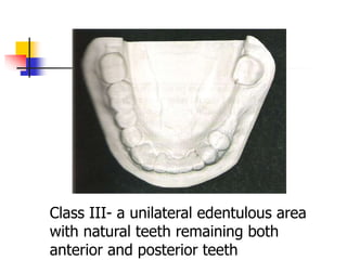 Classification of Partially Edentulous Arches.ppt