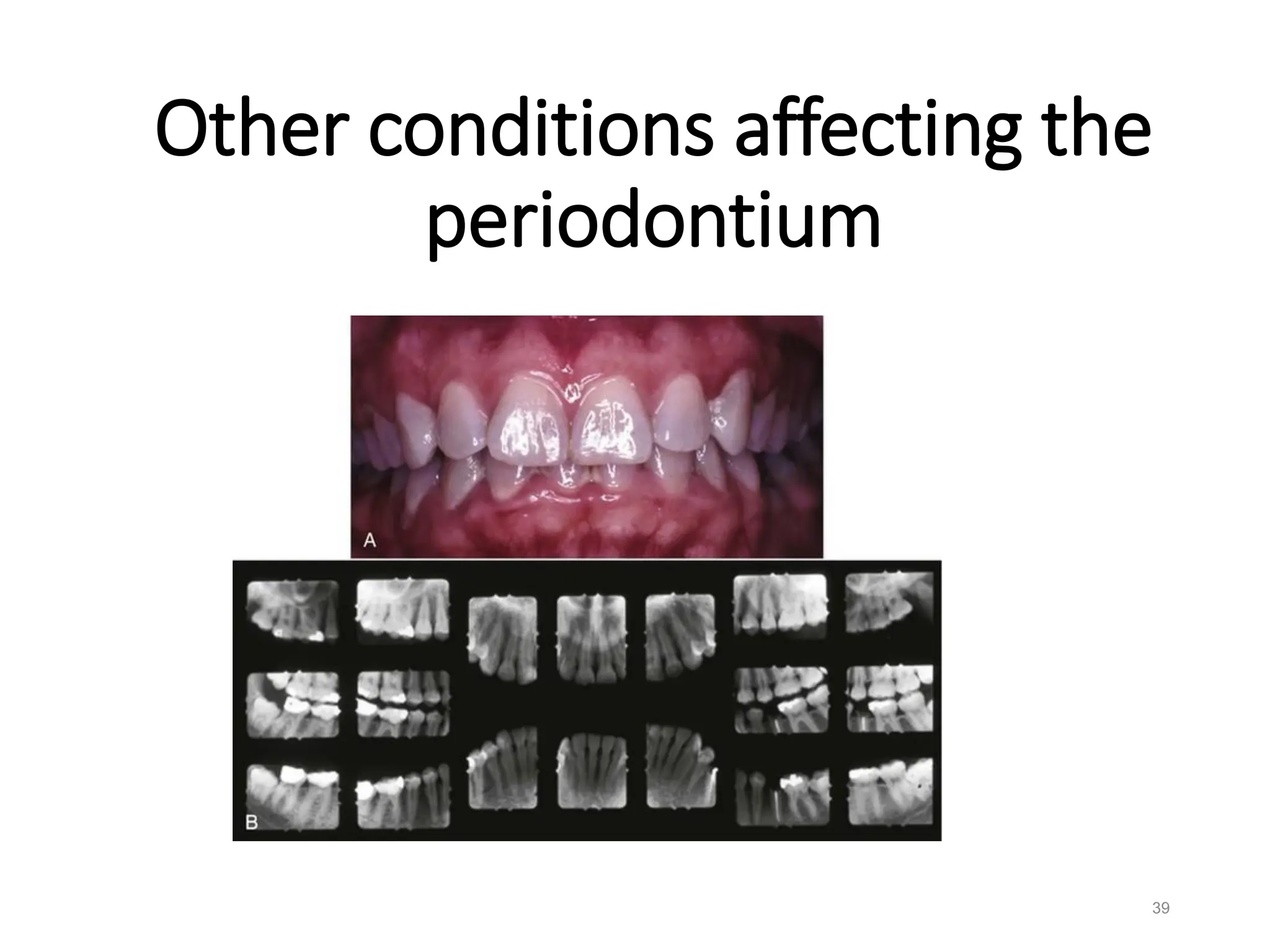 Classification of periodontal Disease .pdf