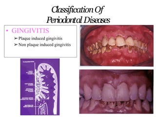 CLASSIFICATION OF PERIODONTAL DISEASE- DR JEEVANAND DESHMUKH.pptx