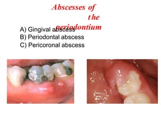 CLASSIFICATION OF PERIODONTAL DISEASE- DR JEEVANAND DESHMUKH.pptx