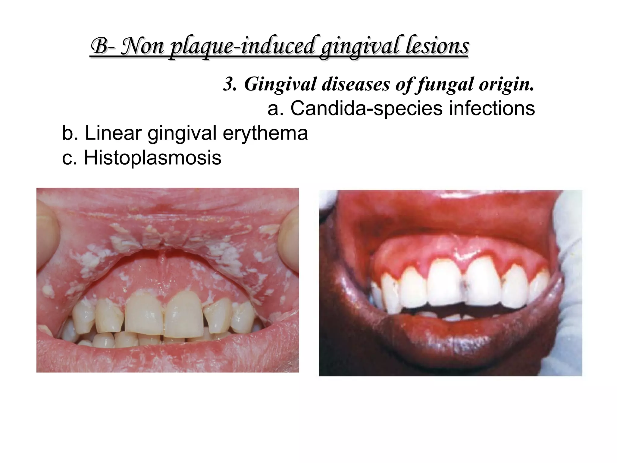Classification of periodontal diseases | PPT