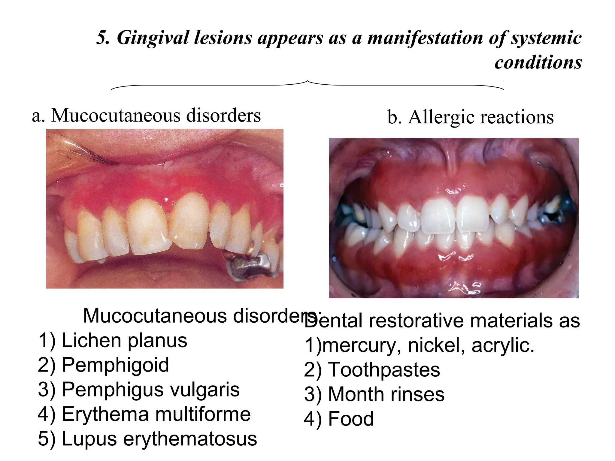 Classification of periodontal diseases | PPT