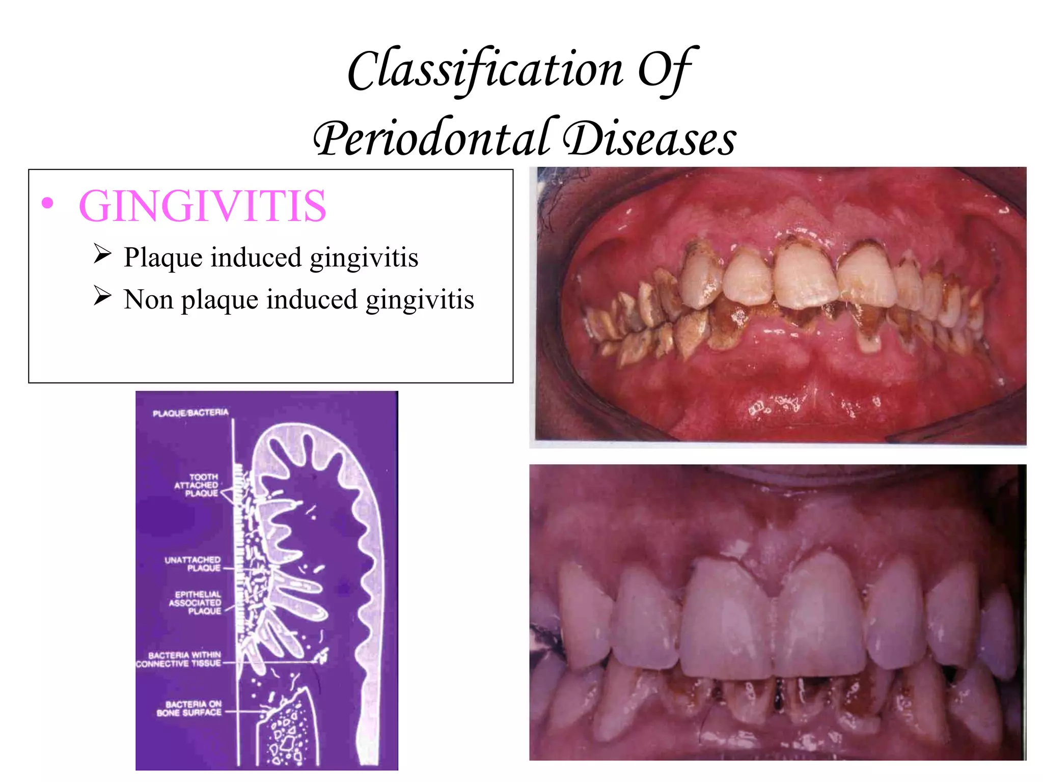 Classification of periodontal diseases | PPT