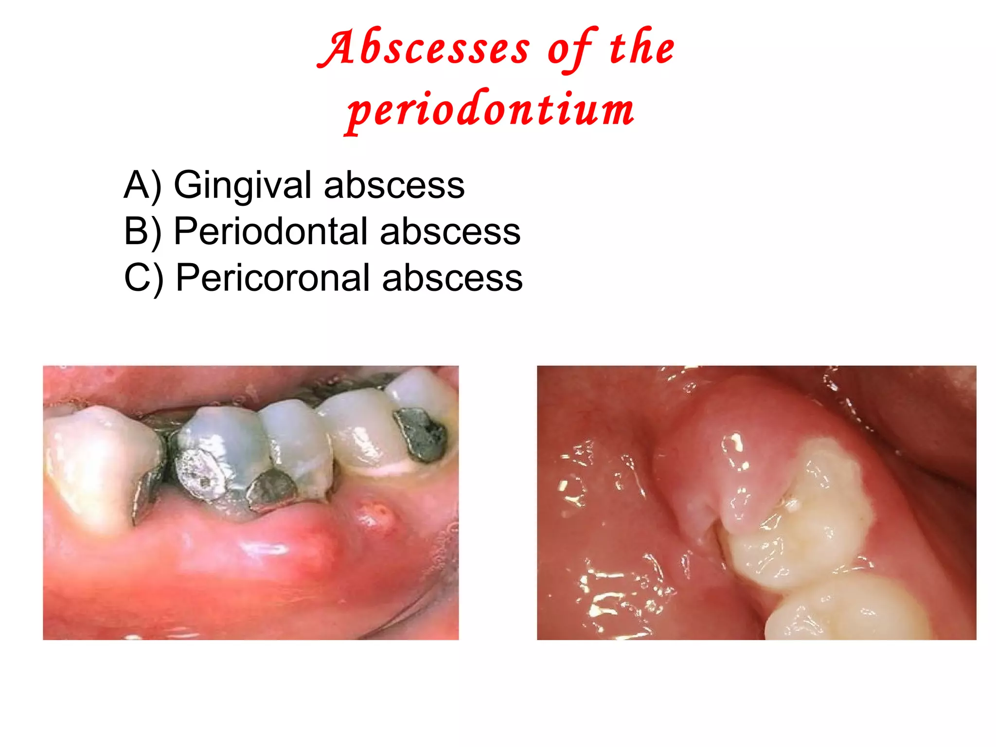 Classification of periodontal diseases | PPT