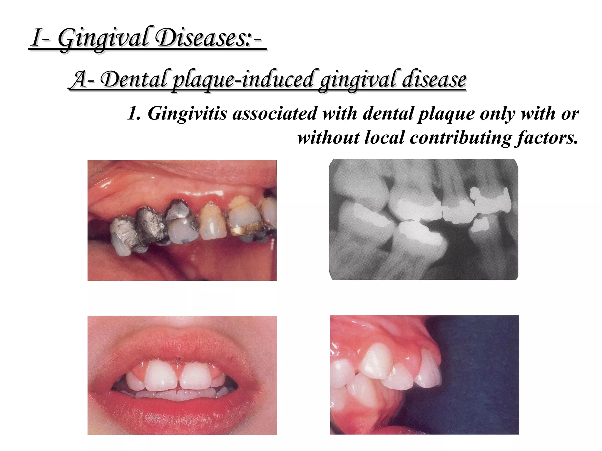 Classification of periodontal diseases | PPT