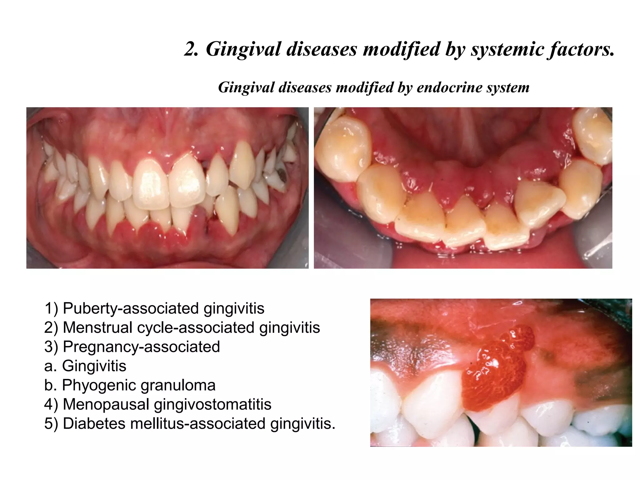 Classification of periodontal diseases | PPT