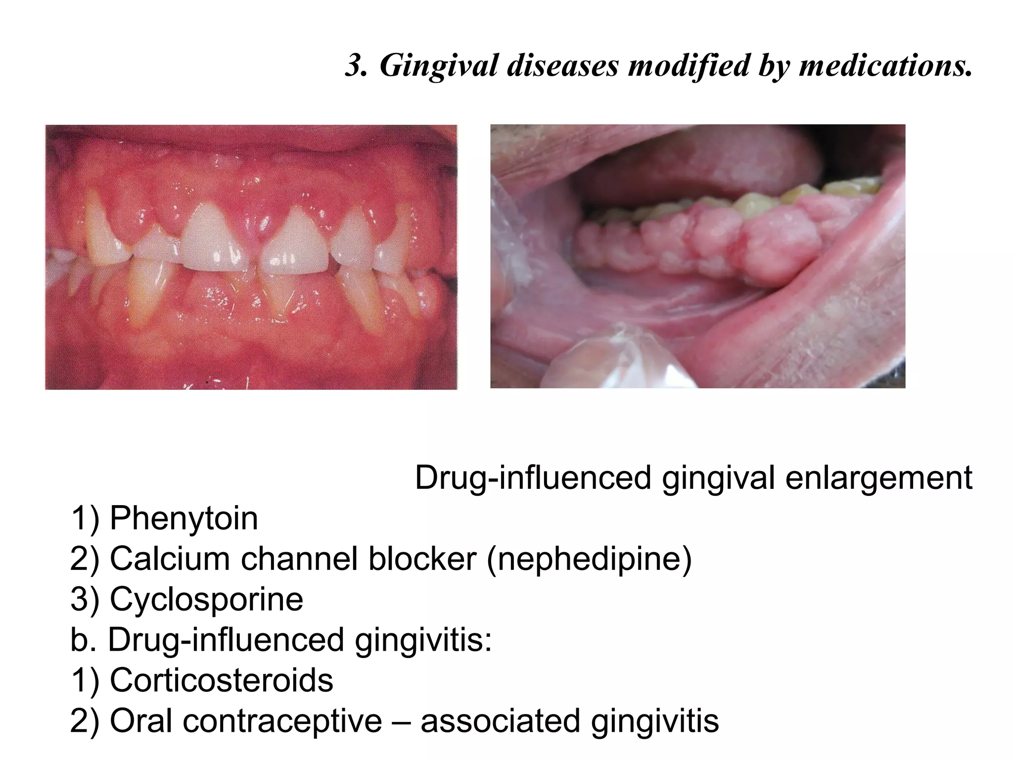 Classification of periodontal diseases | PPT