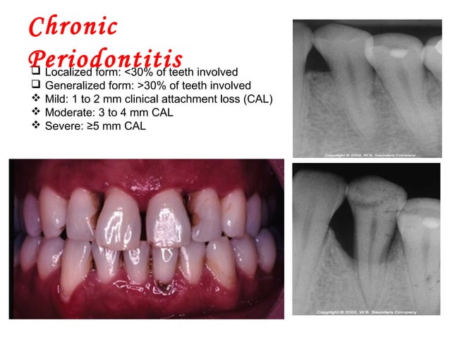 Classification of periodontal diseases | PPT