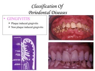 Classification of periodontal diseases | PPT